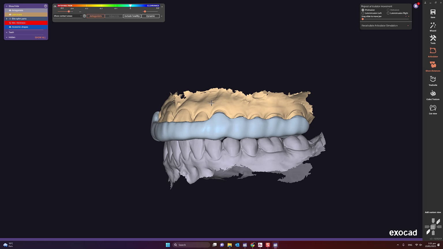 How to 3D Print Splints and Nightguards using Keysplint Soft ...