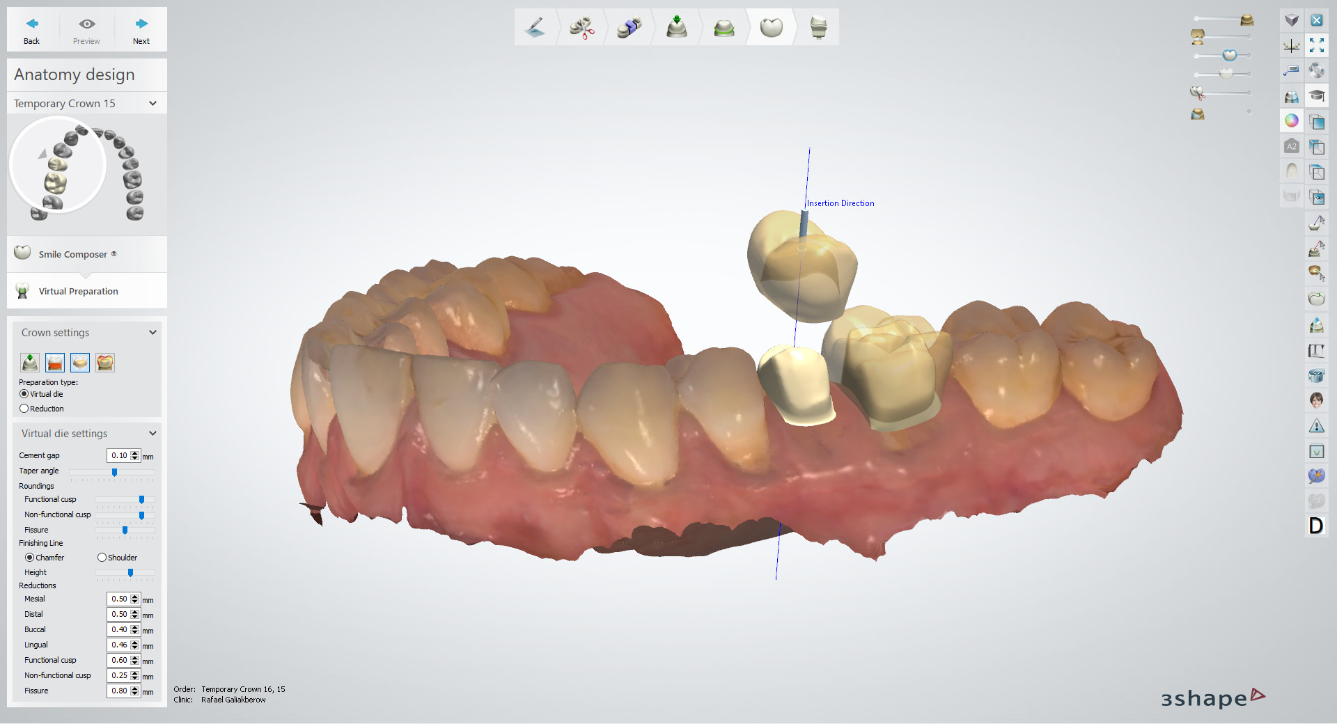 The Impact of Rounded Preps on Dental Restorations