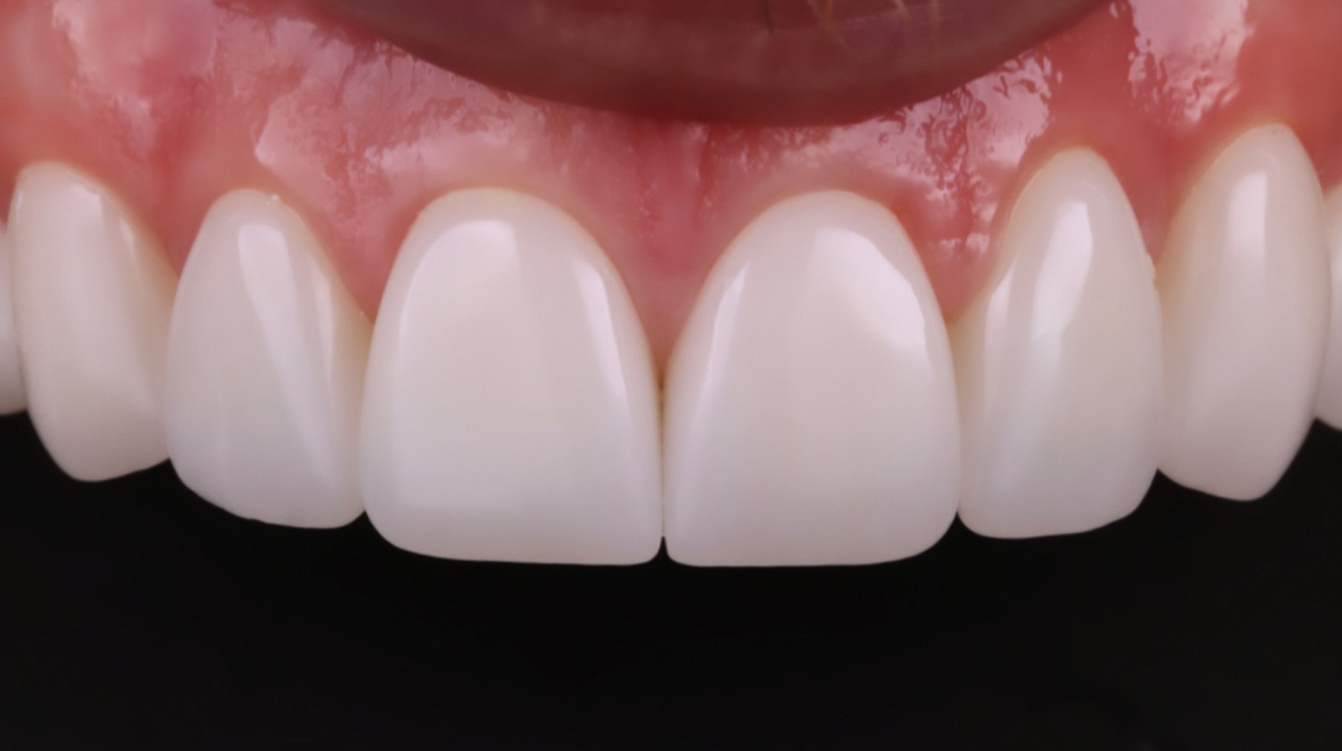 What is exocad? A Comprehensive Overview - Institute of Digital Dentistry