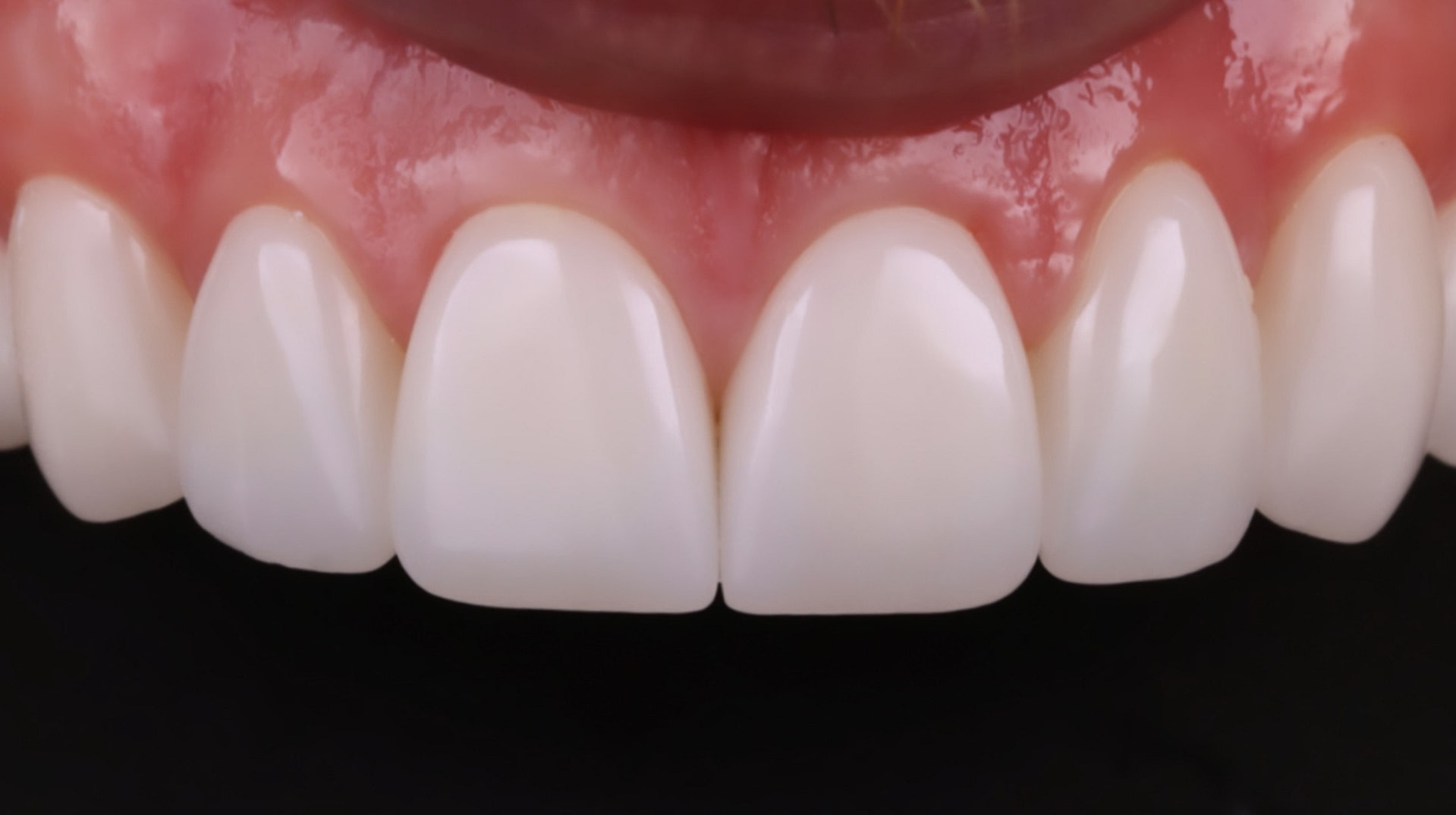 What is exocad? A Comprehensive Overview - Institute of Digital Dentistry