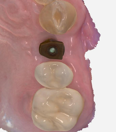 Dental Implant Treatment from Start to Finish using 3Shape TRIOS