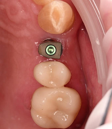 Dental Implant Treatment from Start to Finish using 3Shape TRIOS