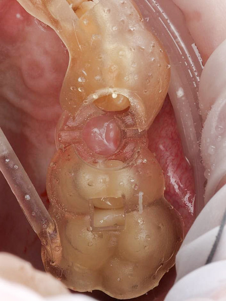 Dental Implant Treatment from Start to Finish using 3Shape TRIOS