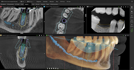 DEXIS IS 3800 Wireless Intraoral Scanner Review by iDD