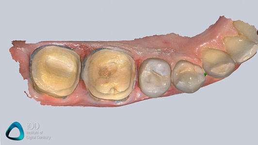 Straumann SIRIOS Intraoral Scanner Review by iDD