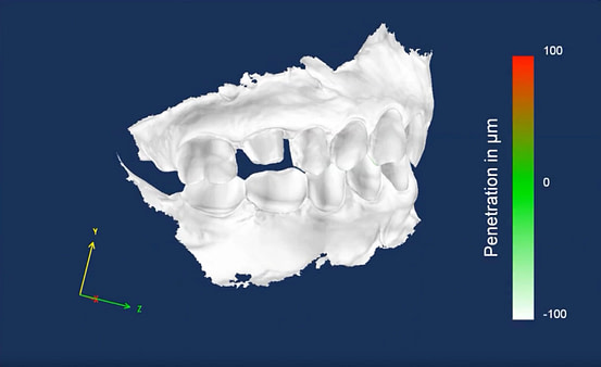 Bite-Finder at IDS 2023: Enhancing Dental Occlusion with AI Technology