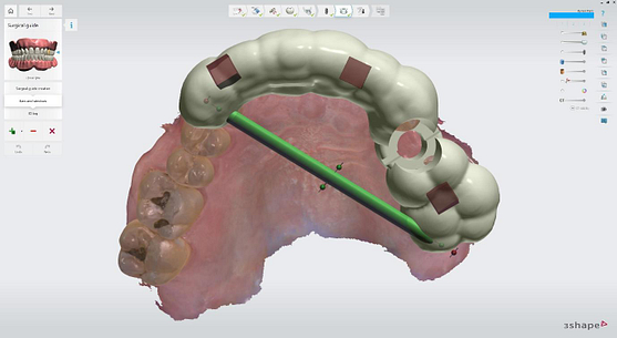Dental Implant Treatment from Start to Finish using 3Shape TRIOS