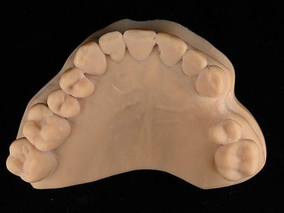 Dental Implant Treatment from Start to Finish using 3Shape TRIOS