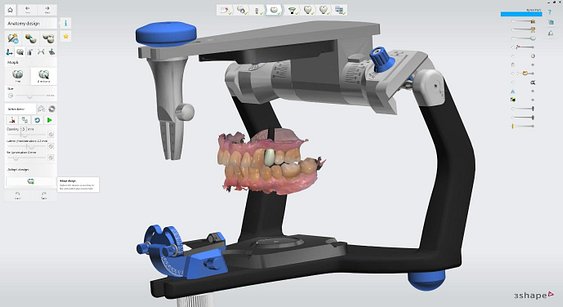 Dental Implant Treatment from Start to Finish using 3Shape TRIOS