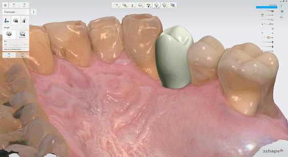 Dental Implant Treatment from Start to Finish using 3Shape TRIOS