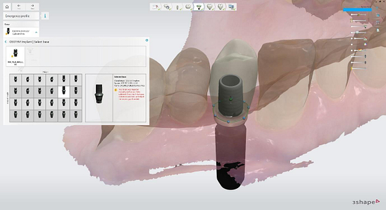 Dental Implant Treatment from Start to Finish using 3Shape TRIOS