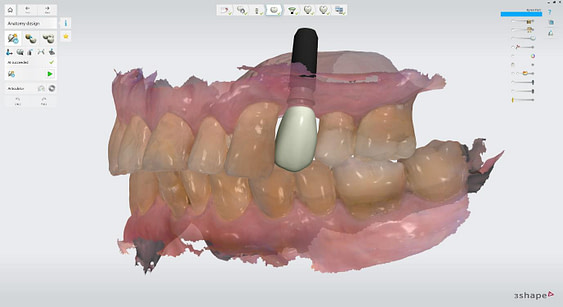 Dental Implant Treatment from Start to Finish using 3Shape TRIOS