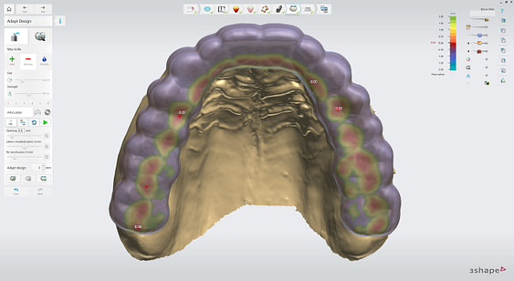 From Scan to Splint: A Step-by-Step 3Shape TRIOS Case Study - Institute of Digital Dentistry