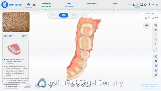 Shining 3D Aoralscan Elite Review by iDD