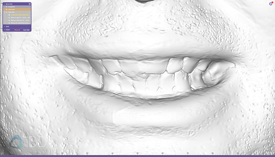 Dental Face Scanner Review and the New Qlone Dental Pro App