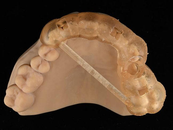 Dental Implant Treatment from Start to Finish using 3Shape TRIOS