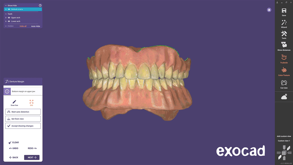 Exocad Showcases 3.2 Elefsina at Insights 2024 - Institute of Digital Dentistry