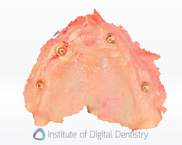How Accurate Is Edentulous Scanning with Intraoral Scanners?