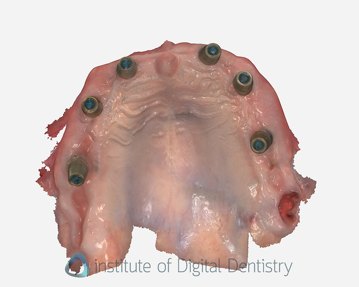 How Accurate Is Edentulous Scanning with Intraoral Scanners?