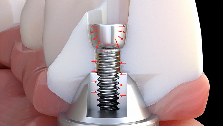 Understanding Prosthetic Screw Designs for Full-Arch Implants
