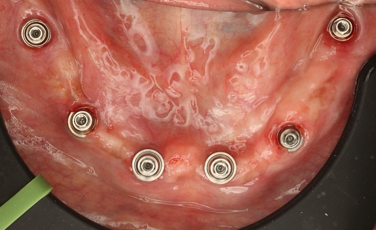 The Nexus IOS Workflow - Restoring Full Arch Implants