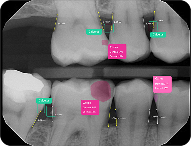Second Opinion by Pearl Review. Dental AI Assisted Diagnostics!