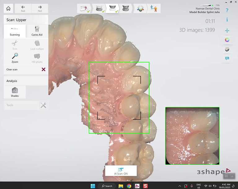 How to 3D Print Splints and Nightguards using Keysplint Soft ...
