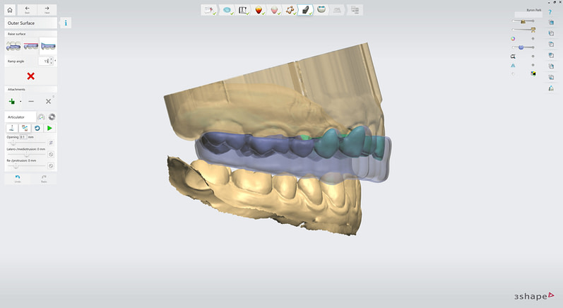 From Scan to Splint: A Step-by-Step 3Shape TRIOS Case Study - Institute of Digital Dentistry