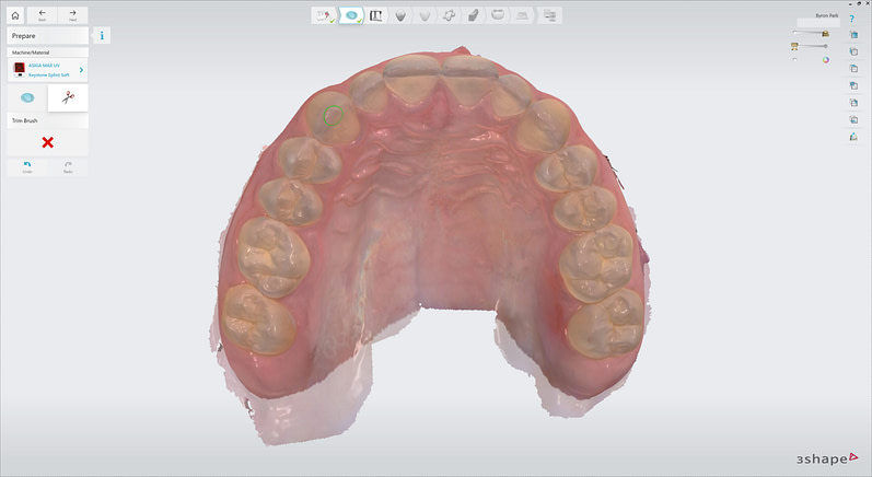 From Scan to Splint: A Step-by-Step 3Shape TRIOS Case Study - Institute of Digital Dentistry