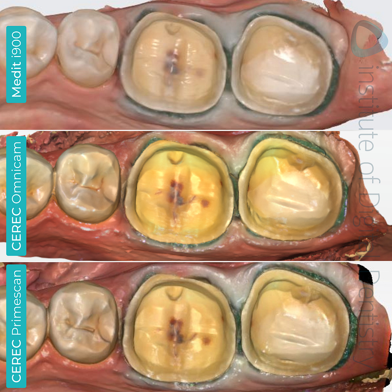 CEREC Omnicam vs. CEREC Primescan vs. Medit i900