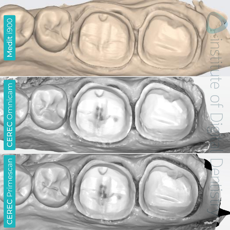 CEREC Omnicam vs. CEREC Primescan vs. Medit i900