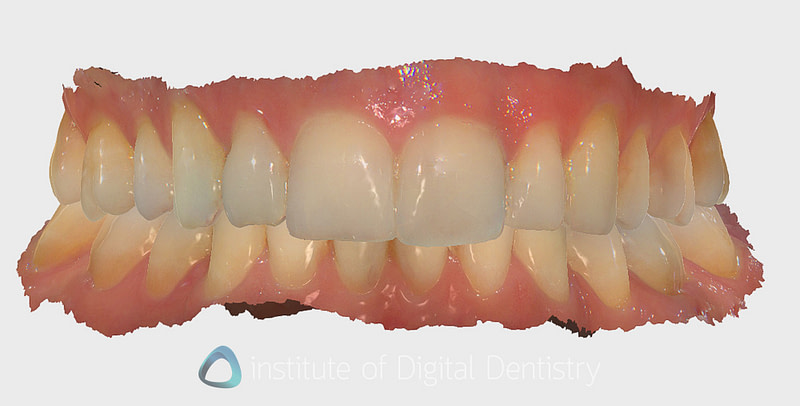 Straumann SIRIOS X3 Intraoral Scanner Review by iDD