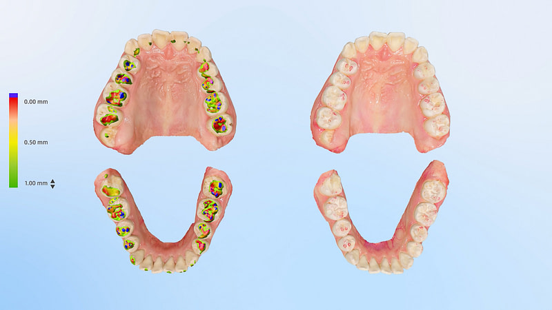 Shining 3D Launches the New Aoralscan Elf - All the Details Here!