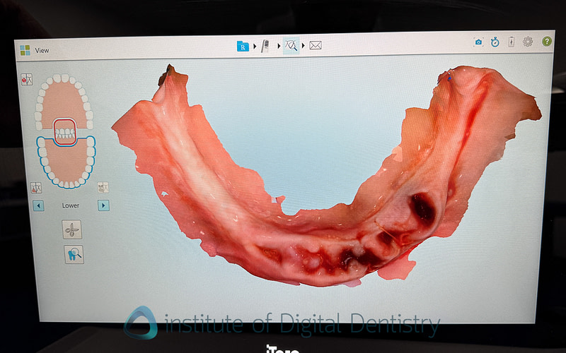 How Accurate Is Edentulous Scanning with Intraoral Scanners?