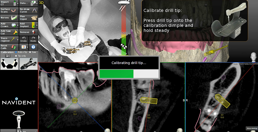 Navident EVO Case Examples - Overview of Dynamic Navigation