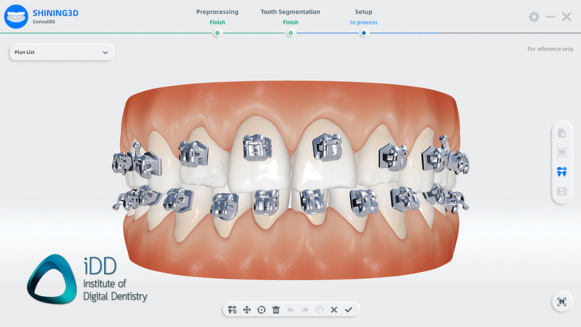 Aoralscan 3 Wireless Intraoral Scanner Review