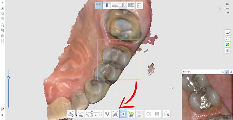 Medit i600 Review - Is this low-cost intraoral scanner worth buying?