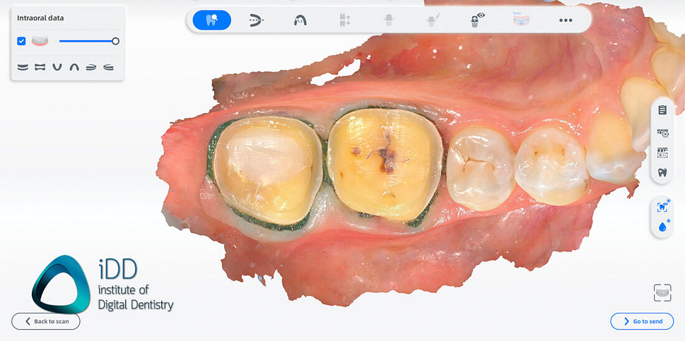 Aoralscan 3 Wireless Intraoral Scanner Review