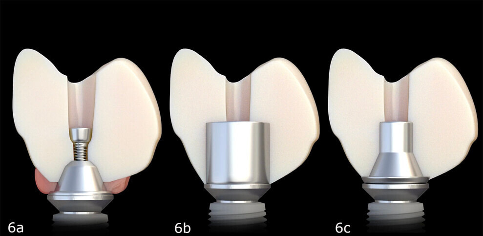 Understanding Prosthetic Screw Designs for Full-Arch Implants