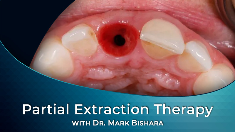 Partial Extraction Therapies & Socket Shield Course - Institute of Digital Dentistry