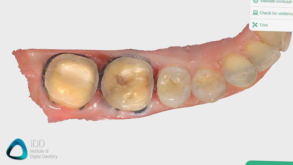 Straumann SIRIOS Intraoral Scanner Review by iDD